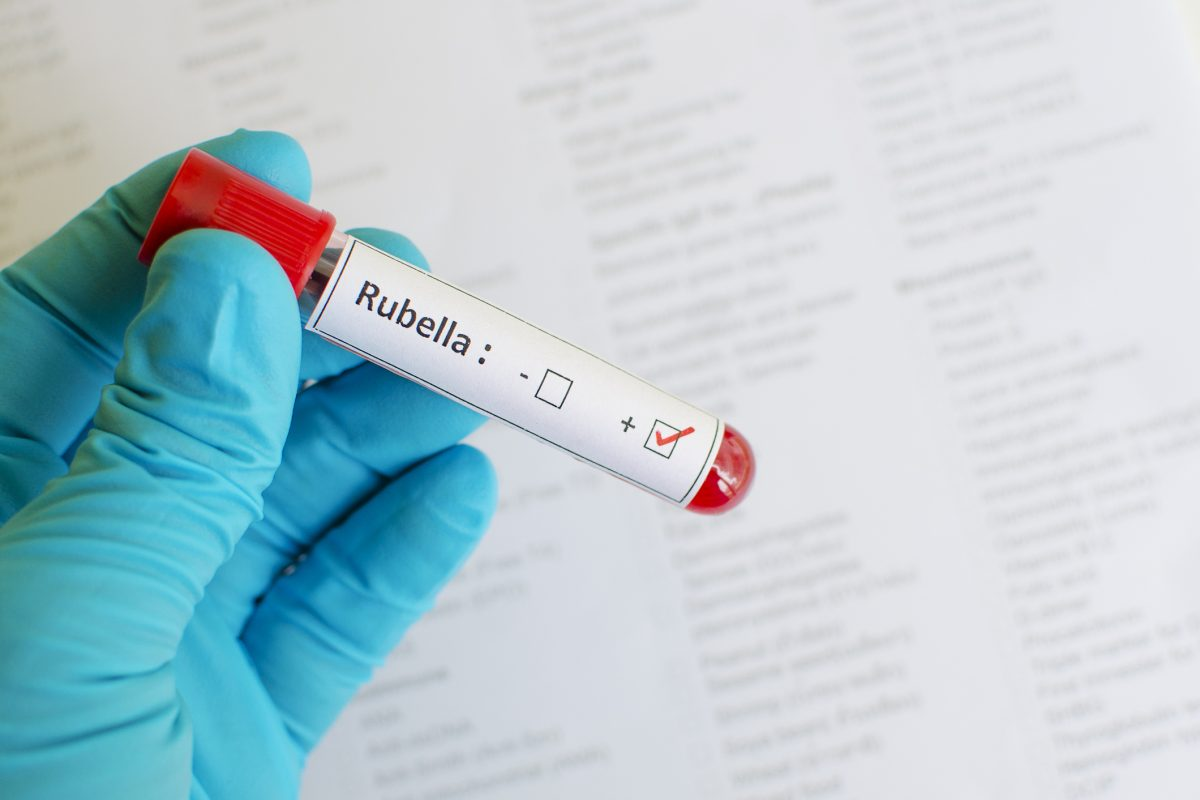 Positive For Rubella Igg In Pregnancy